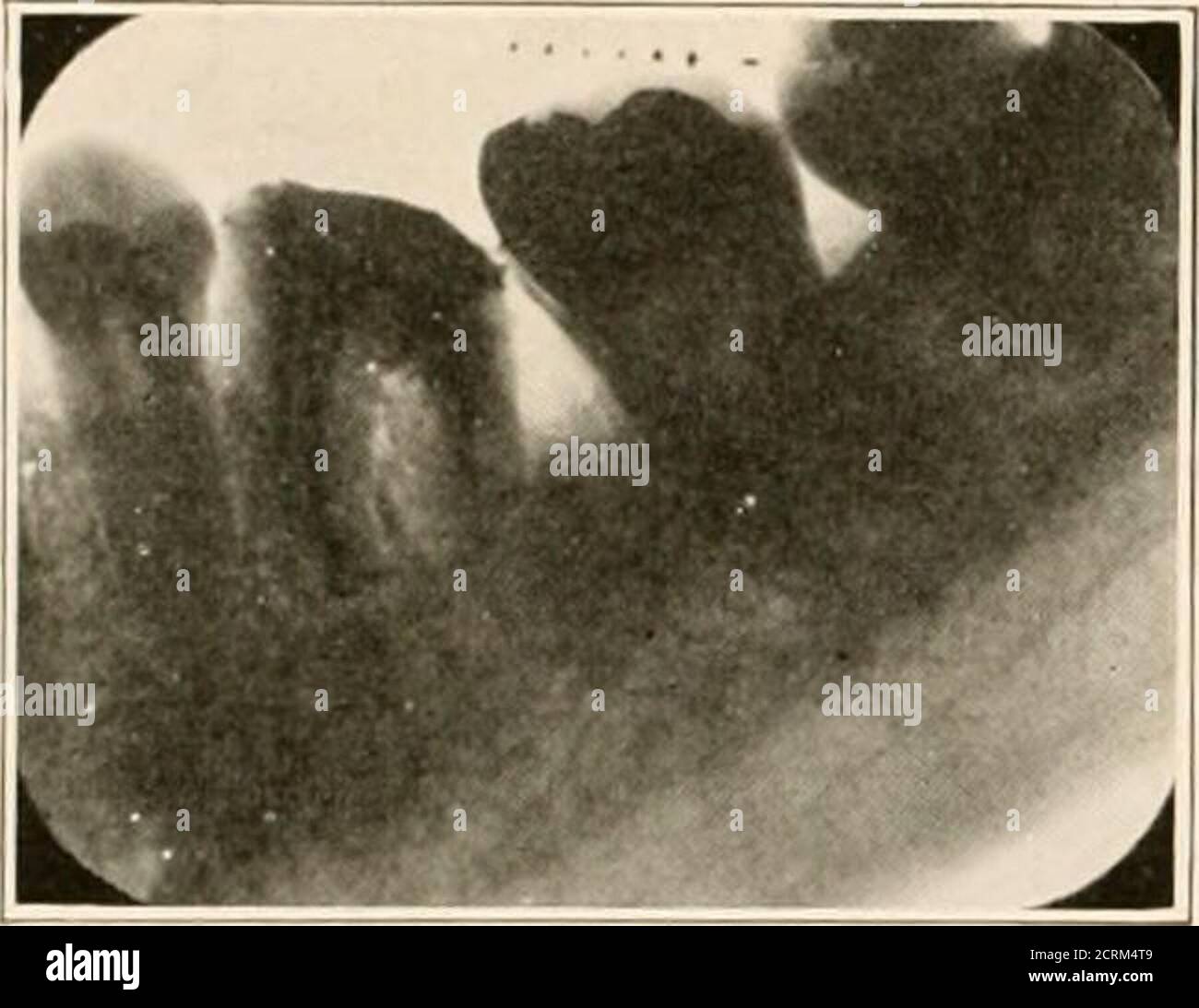 . Oral sepsis in its relationship to systemic disease . Fig. 150 ...