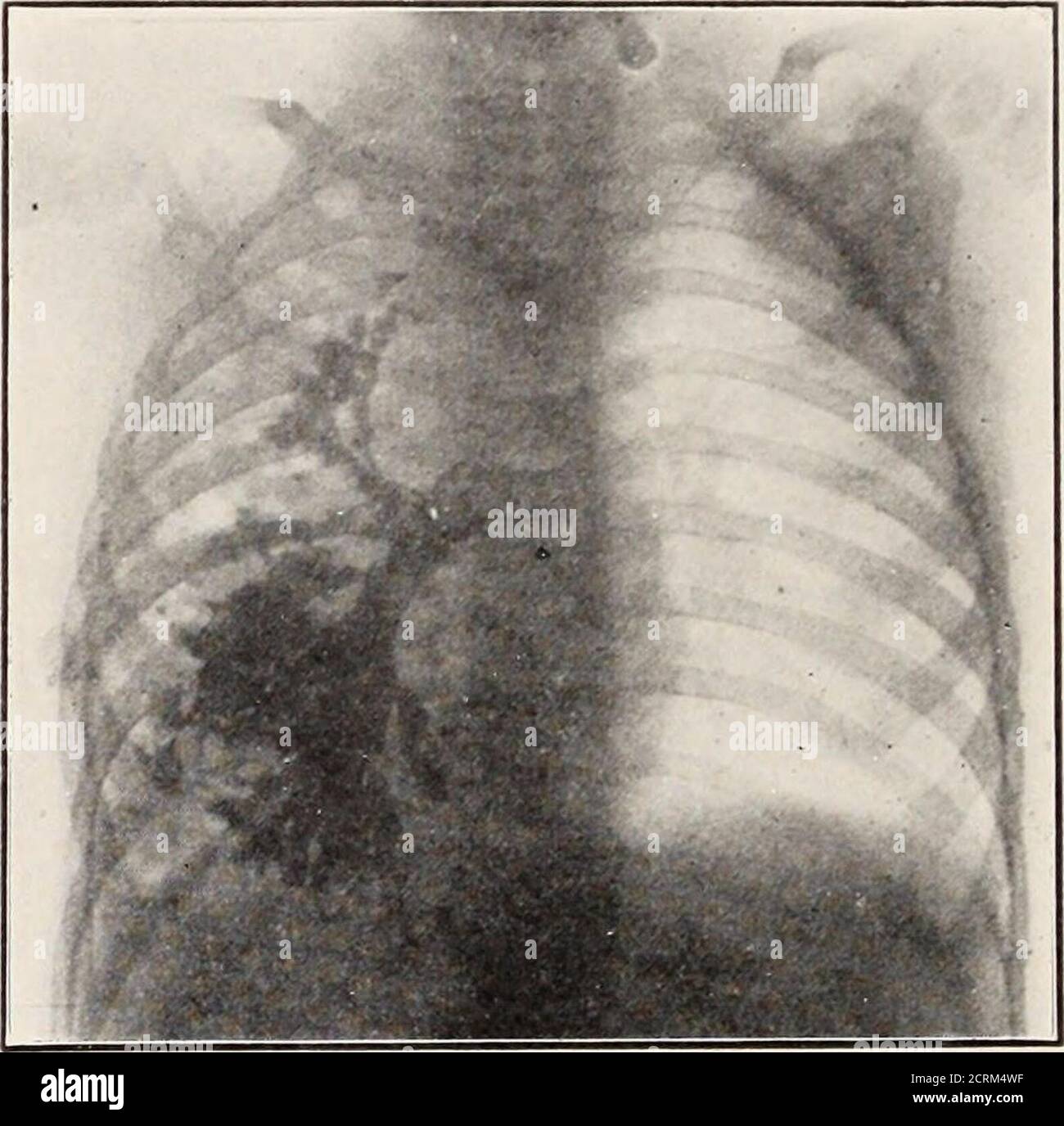 Subacromial bursa hi-res stock photography and images - Alamy