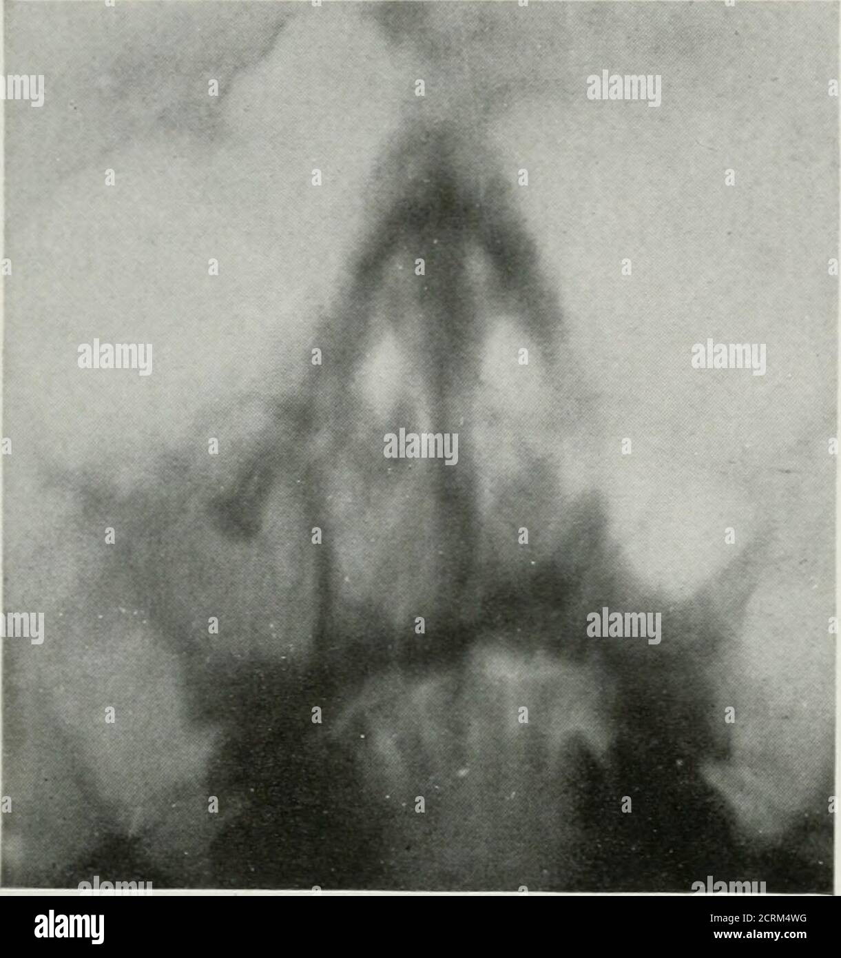 Bone spicules hi-res stock photography and images - Alamy