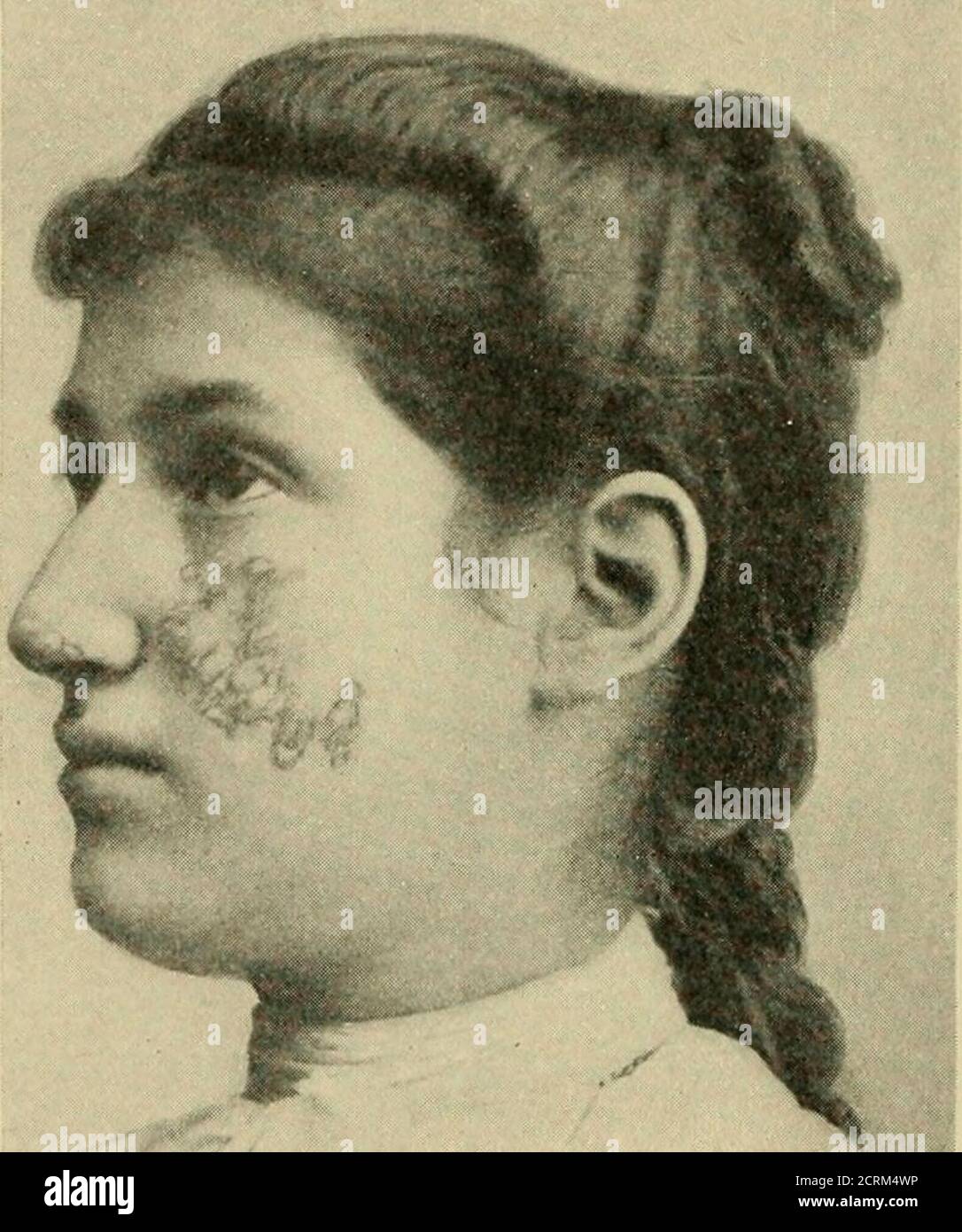 . Radiotherapy and phototherapy : including radium and high-frequency ...