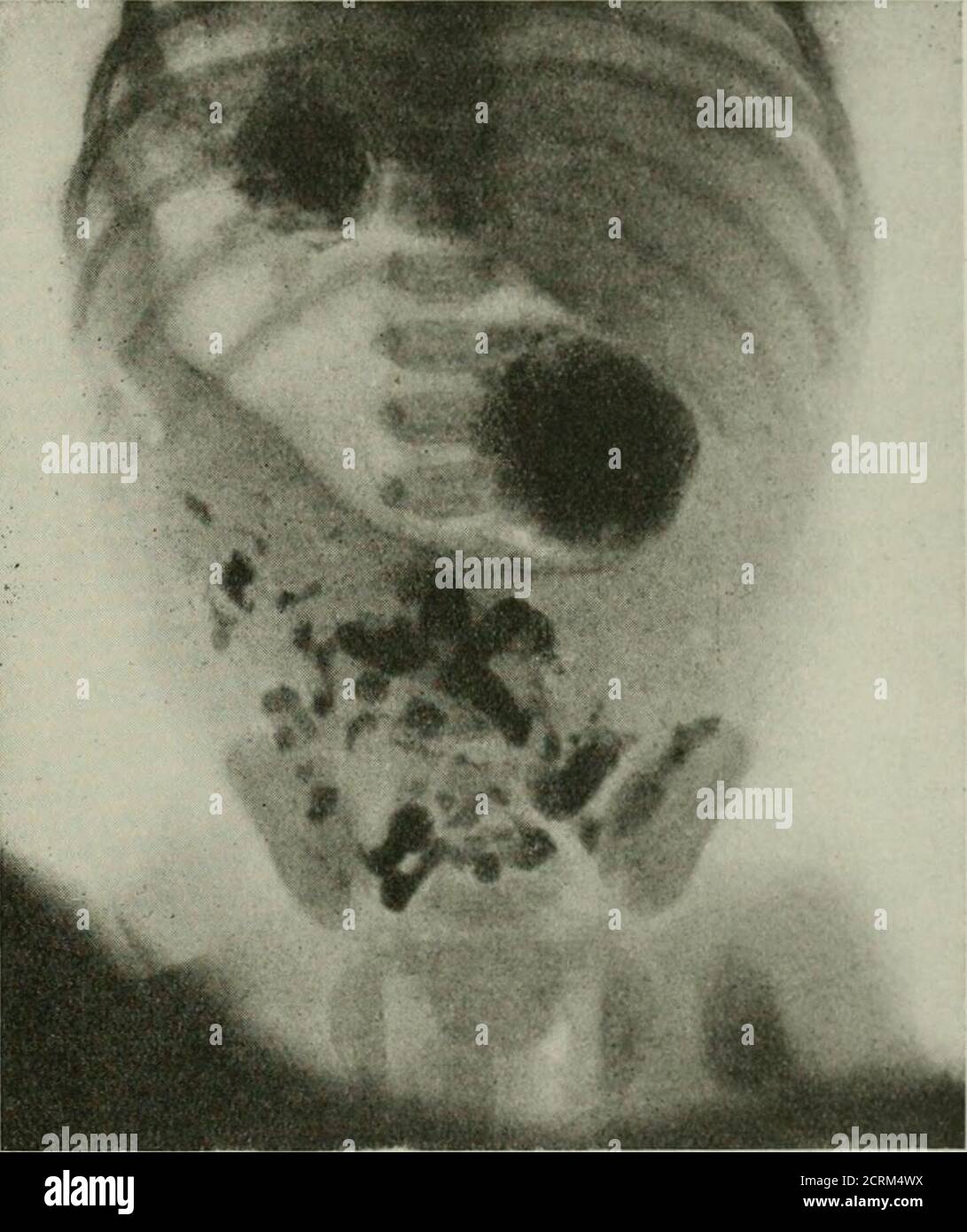 . Radiography and radio-therapeutics . pylorospasm,describes the appear ...