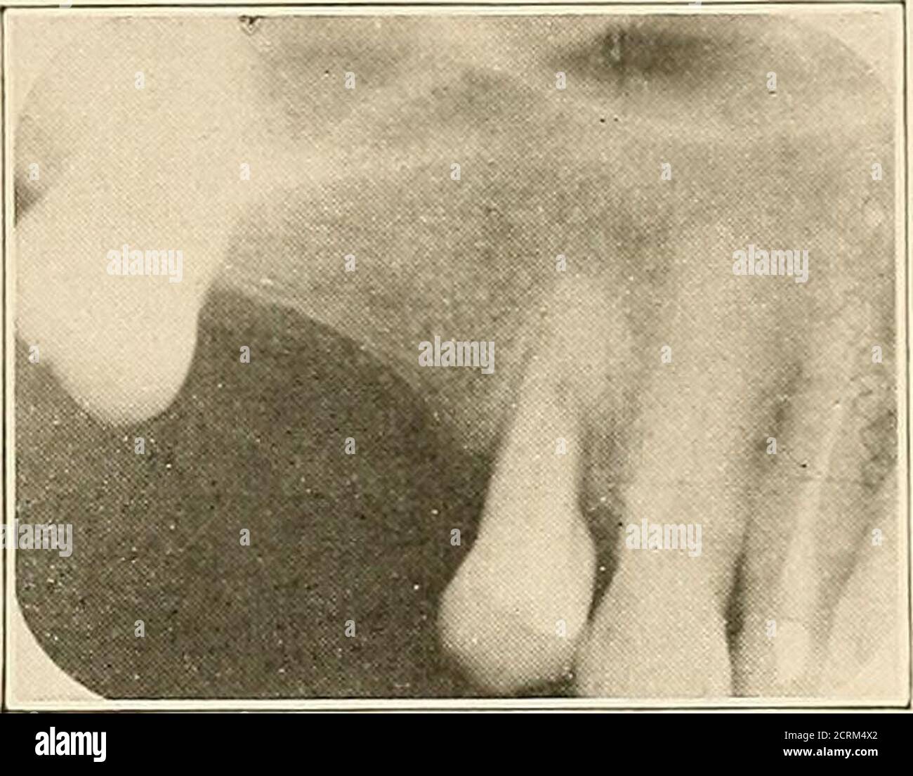 . Interpretation of dental & maxillary roentgenograms . Fig. 132. Fig ...