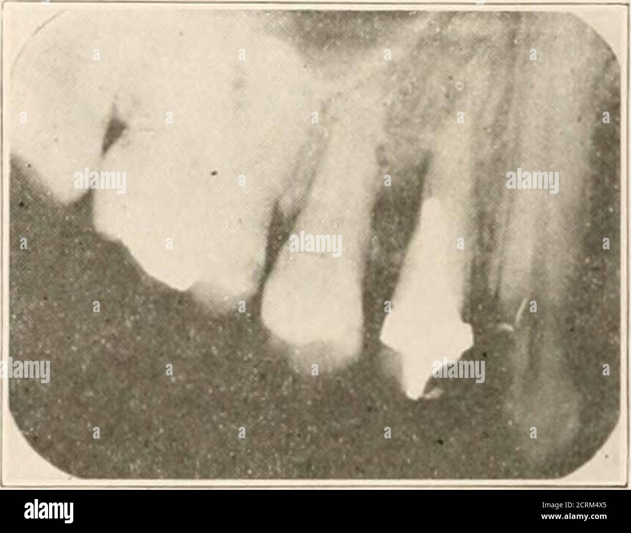 . Interpretation of dental & maxillary roentgenograms . Fig. 132. Fig ...