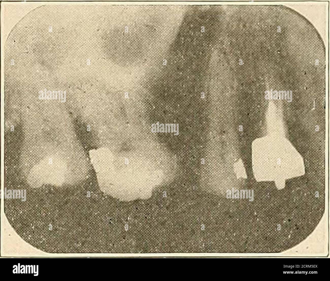 Maxillary second molar hi-res stock photography and images - Alamy