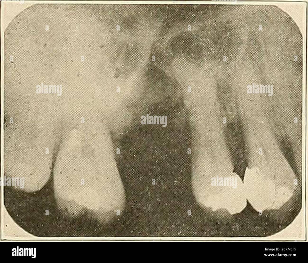 . Interpretation of dental & maxillary roentgenograms . Fig. 126. Fig ...