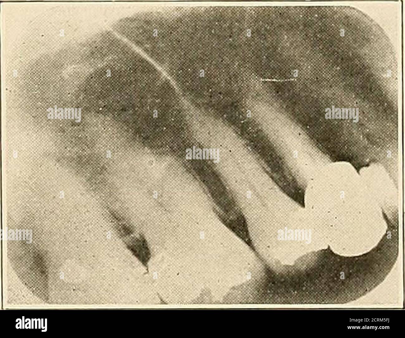 . Interpretation of dental & maxillary roentgenograms . Fig. 128. Fig ...