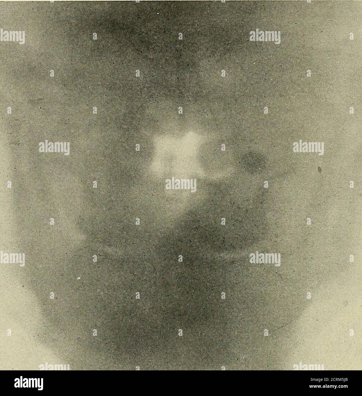 . Röntgen ray diagnosis and therapy . Fig. 43.—Bullet in the Skull ...