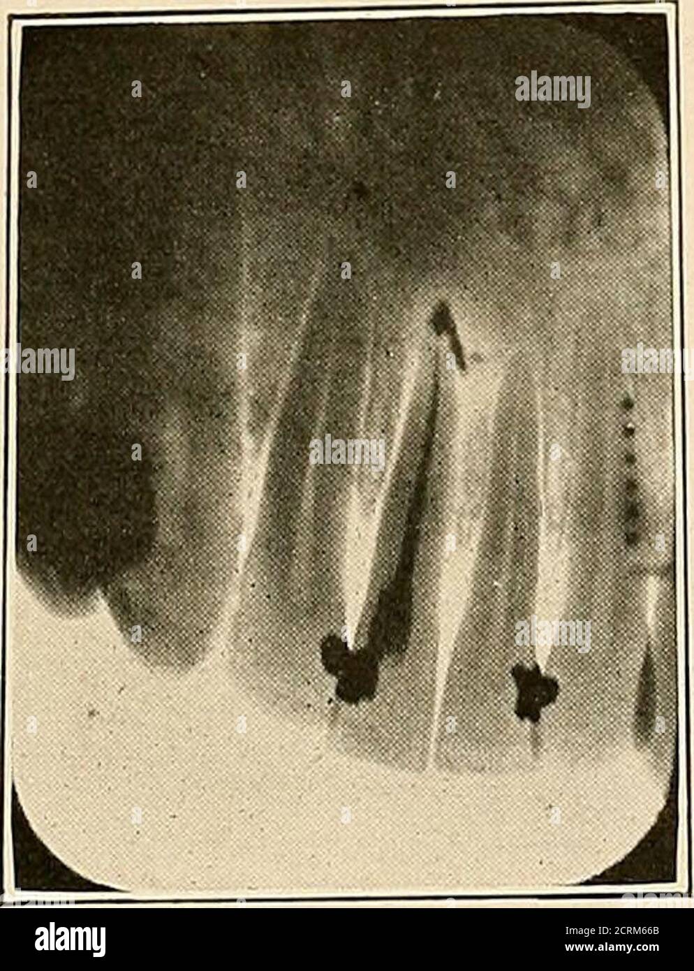 . Oral sepsis in its relationship to systemic disease . Fig. 140. Fig ...