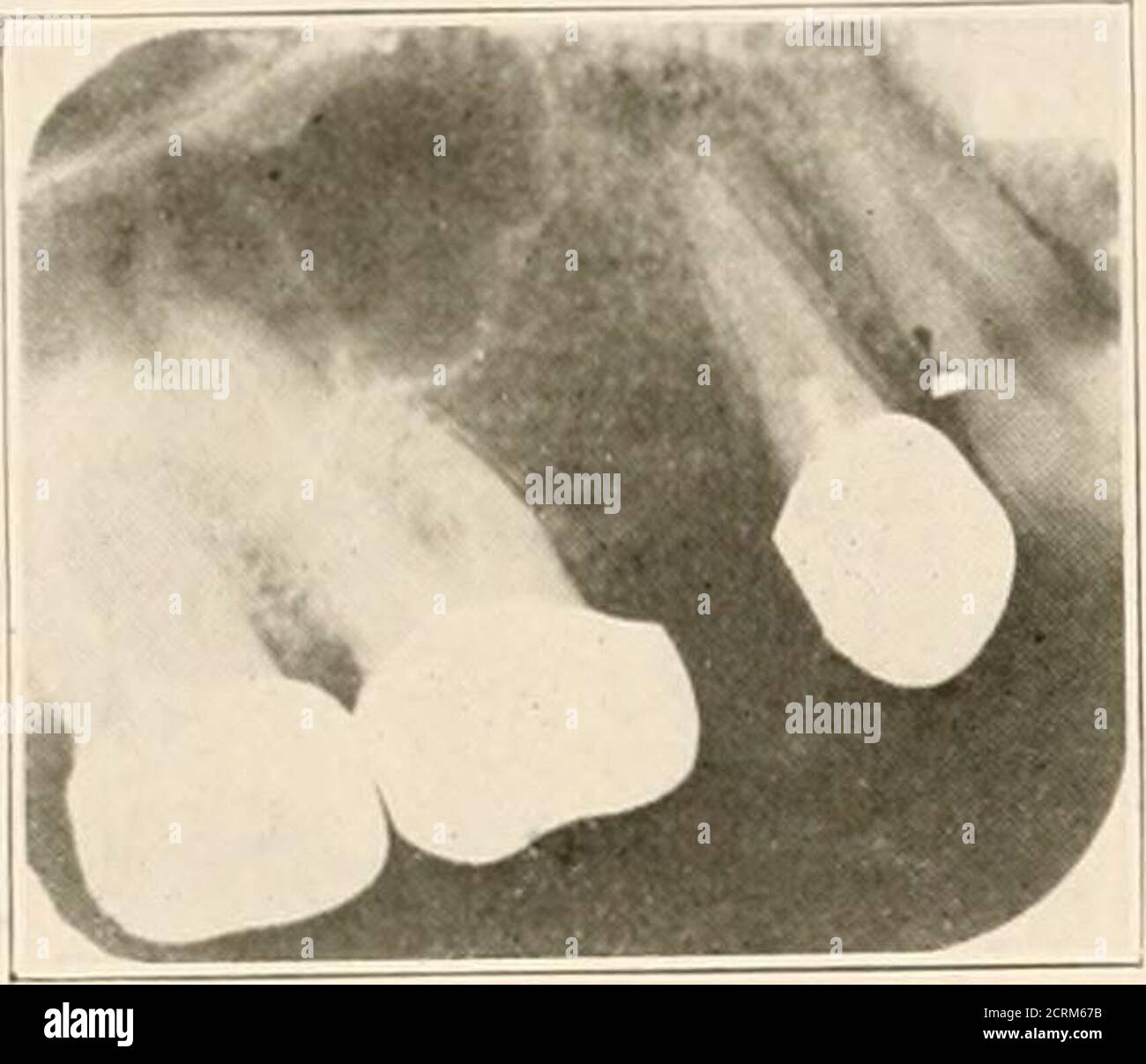 . Interpretation of dental & maxillary roentgenograms . Fig. 120. Fig ...