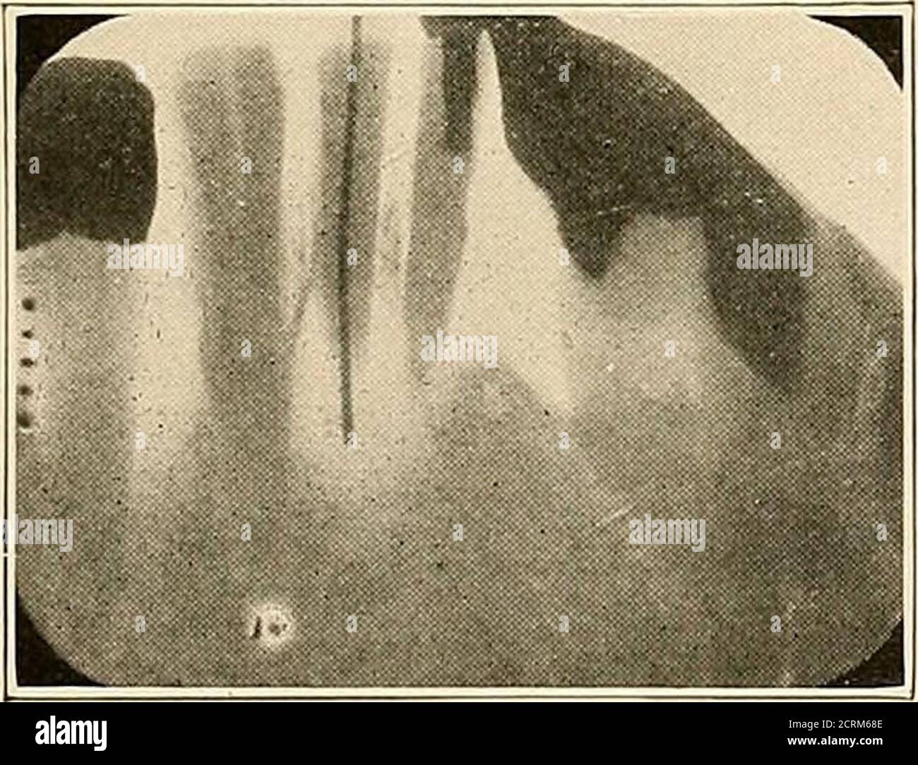 . Oral sepsis in its relationship to systemic disease . Fig. 142.. Fig ...