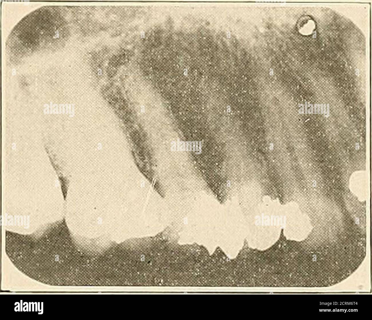 . Interpretation of dental & maxillary roentgenograms . Fig. 118. Fig ...