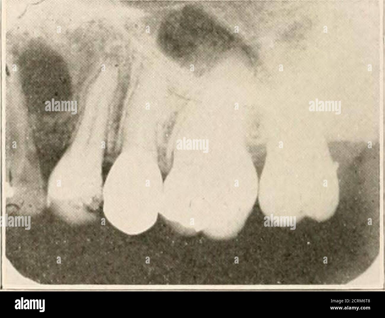 . Interpretation of dental & maxillary roentgenograms . Fig. 116. Fig ...