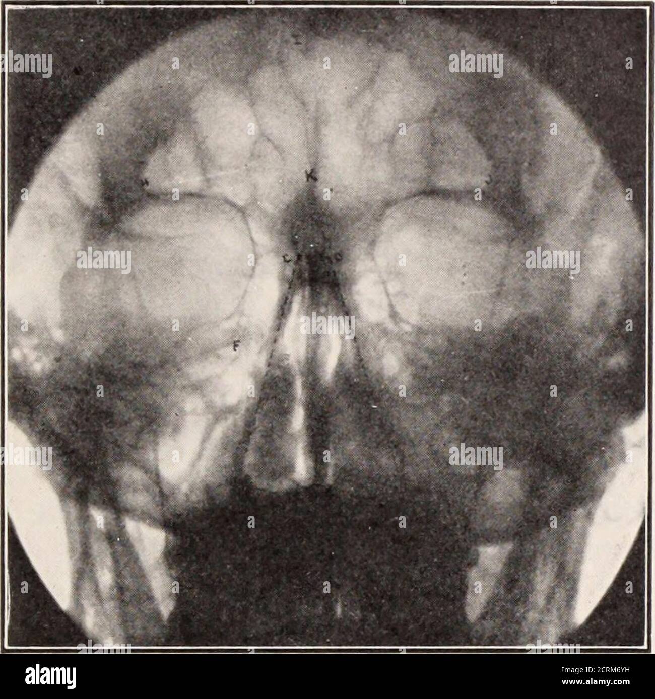 . Journal of roentgenology . stero-anterior quadrilateral of the ...