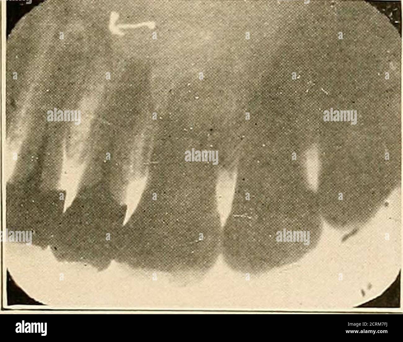 . Oral sepsis in its relationship to systemic disease . Fig. 125. Fig ...
