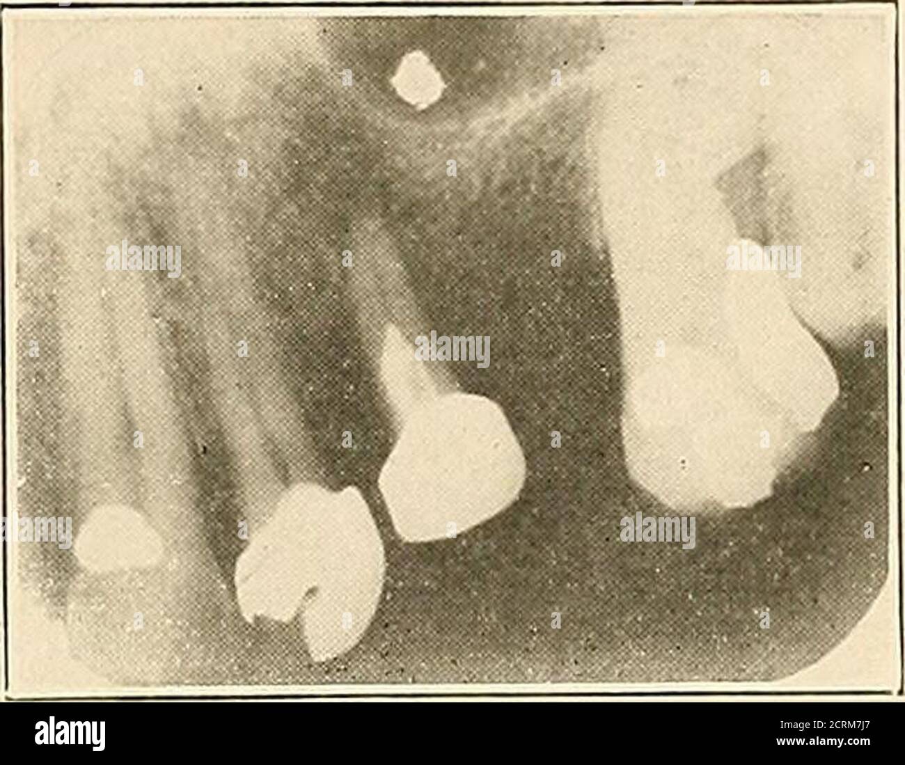 . Interpretation of dental & maxillary roentgenograms . Fig. 110. Fig ...