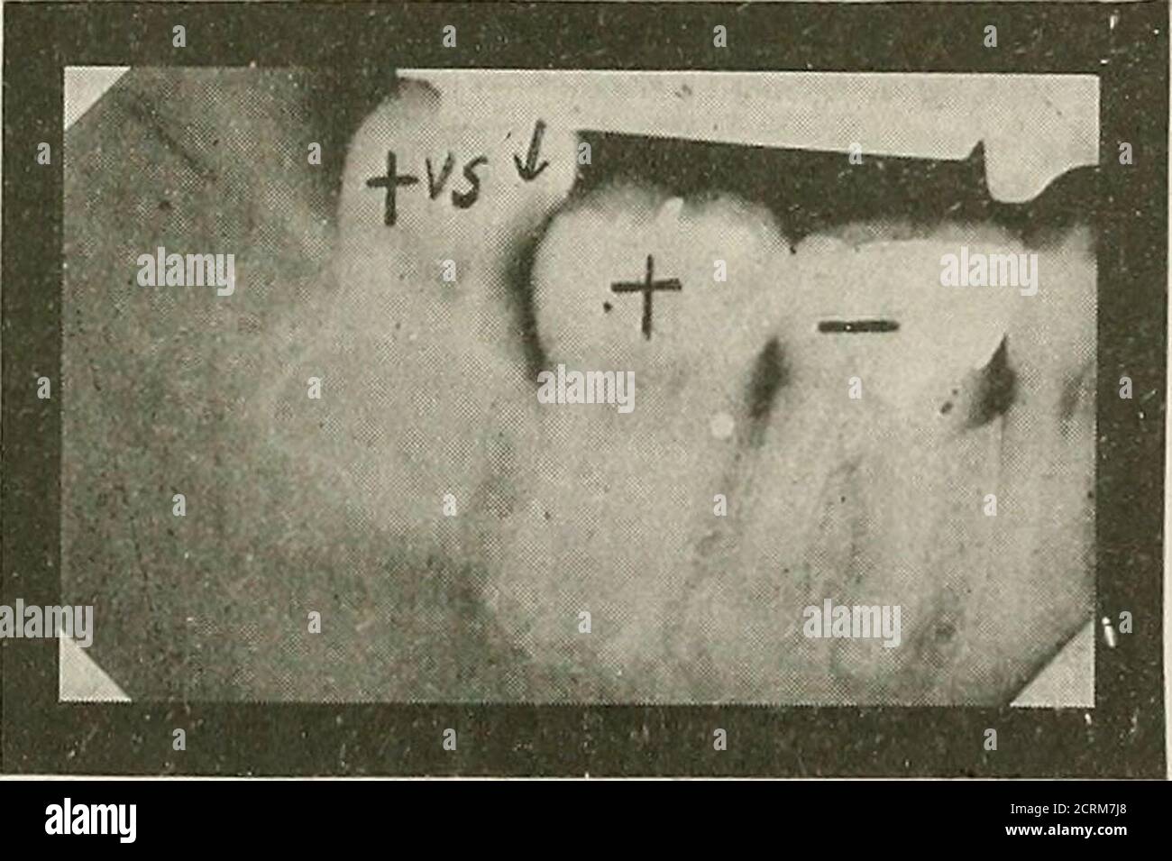 . Electro-radiographic diagnosis; a book on the electric test for pulp ...