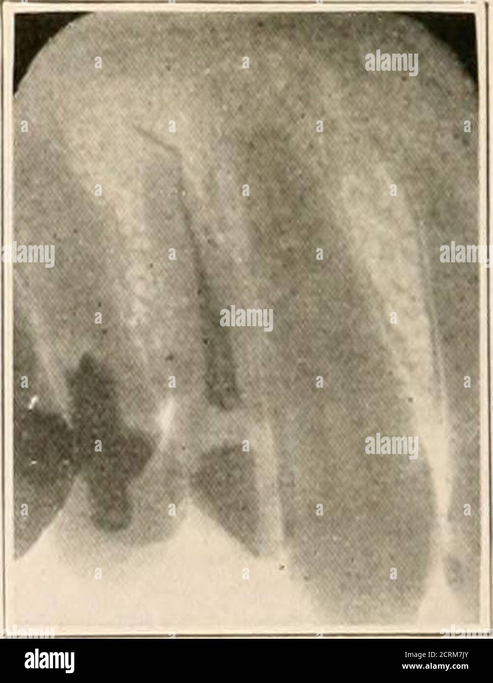 . Oral sepsis in its relationship to systemic disease . Fig. 123. Fig ...