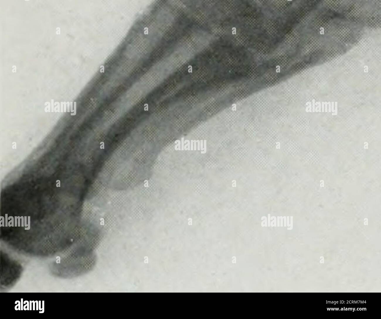 Epiphysitis hi-res stock photography and images - Alamy