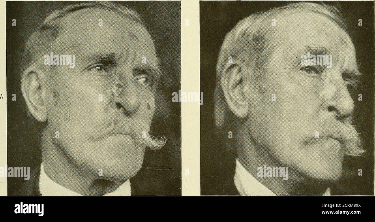 . Radiography and radio-therapeutics . PLATE LXXXVII.—Rodent Ulcers ...