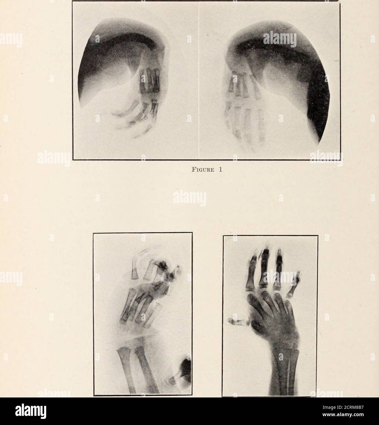 Hand deformities hi-res stock photography and images - Alamy