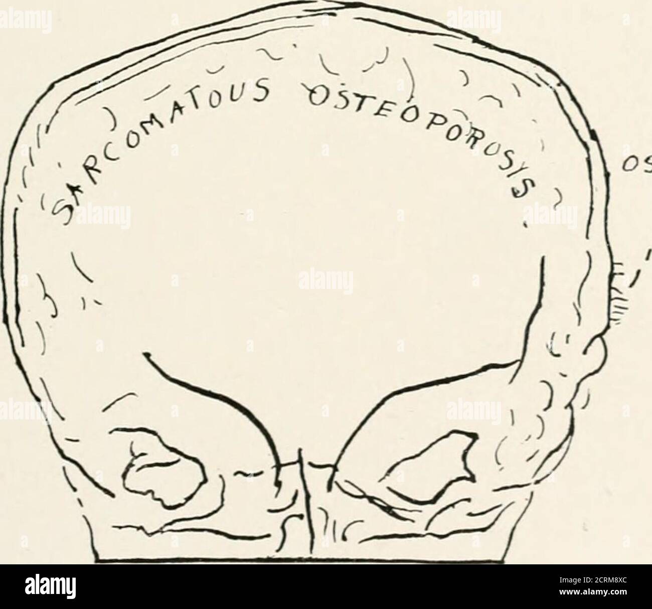 . Roentgen diagnosis of diseases of the head . Fig. 29.—An ...