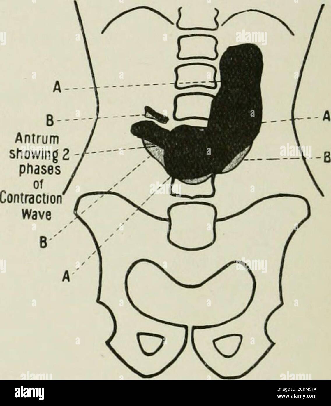 . Radiography and radio-therapeutics . Fig. 288.—Stomach showing ...