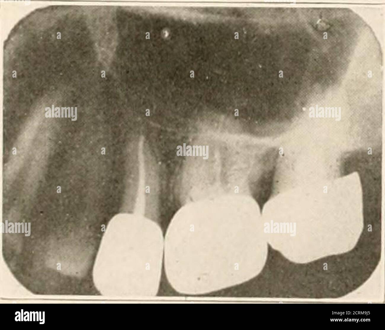 . Interpretation of dental & maxillary roentgenograms . Fig. 98. Fig ...