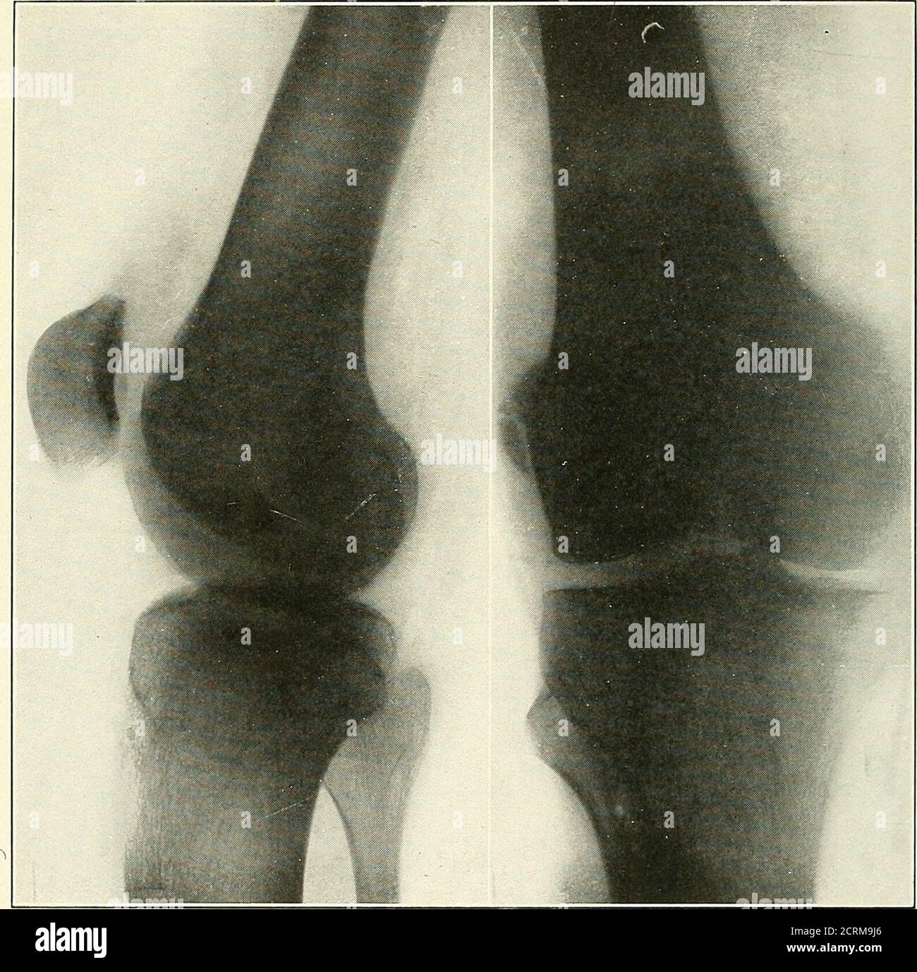 Olecranon process fracture hi-res stock photography and images - Alamy