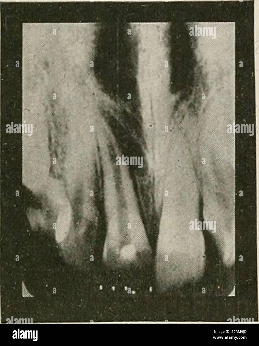 Dental crown development hi-res stock photography and images - Alamy