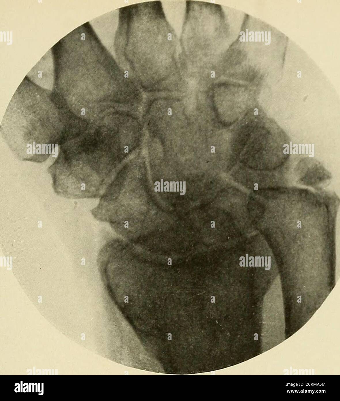 Styloid fracture hi-res stock photography and images - Alamy