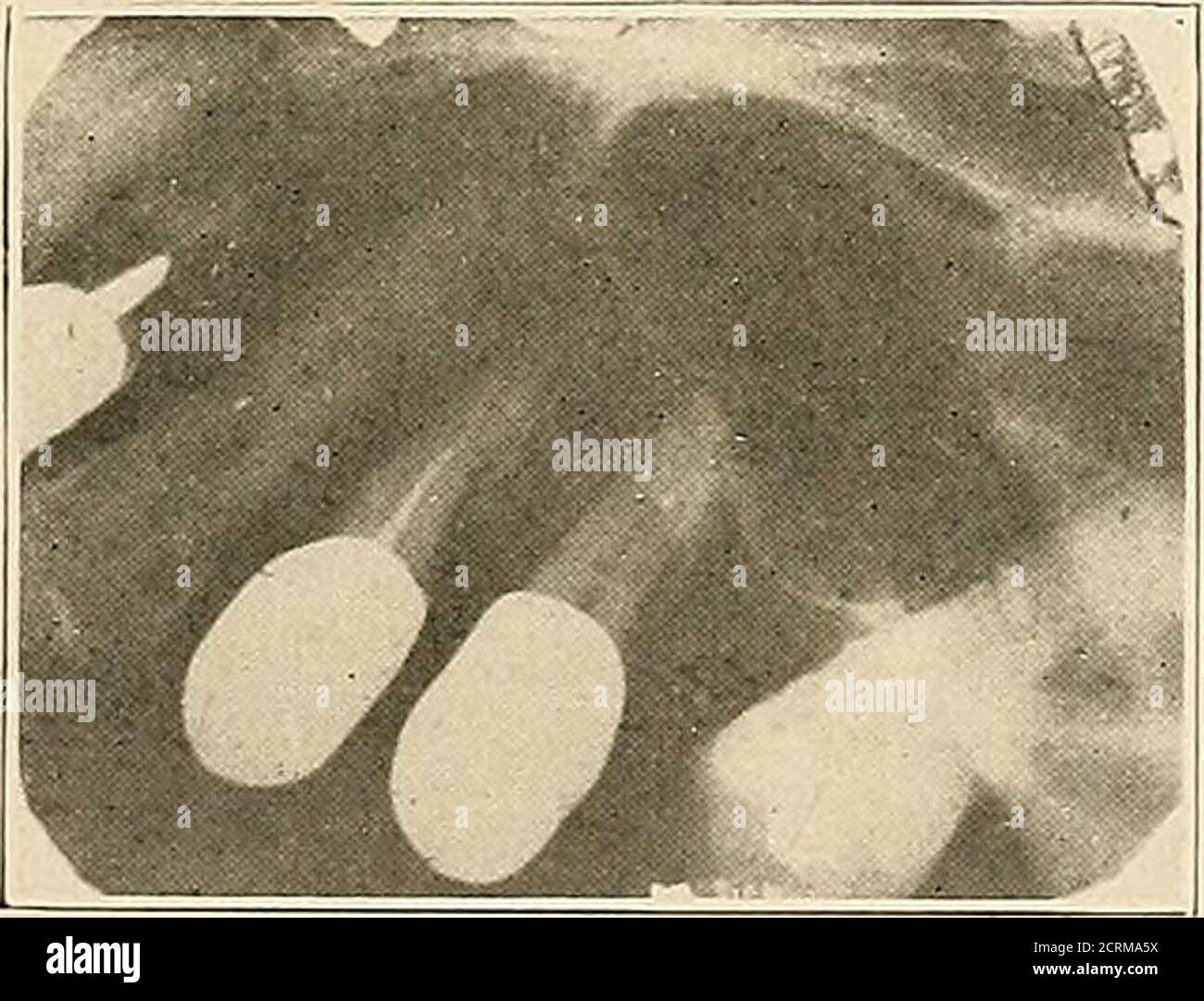 . Interpretation of dental & maxillary roentgenograms . Pig. 94. Fig ...