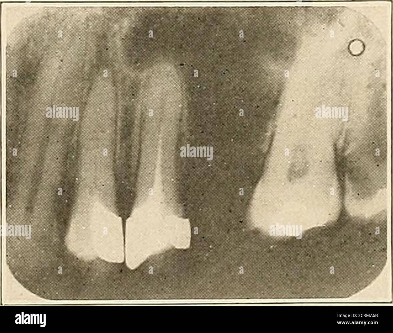 . Interpretation of dental & maxillary roentgenograms . Fig. 96. Fig ...