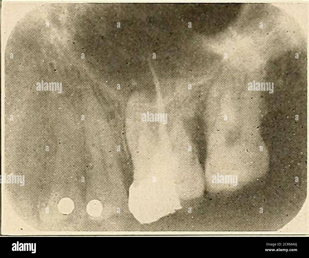 . Interpretation of dental & maxillary roentgenograms . Pig. 94. Fig ...