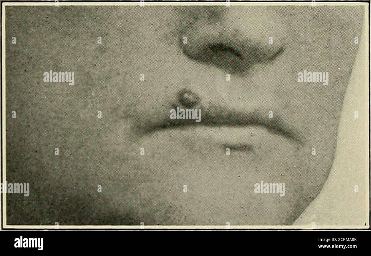 . Radiotherapy and phototherapy : including radium and high-frequency ...