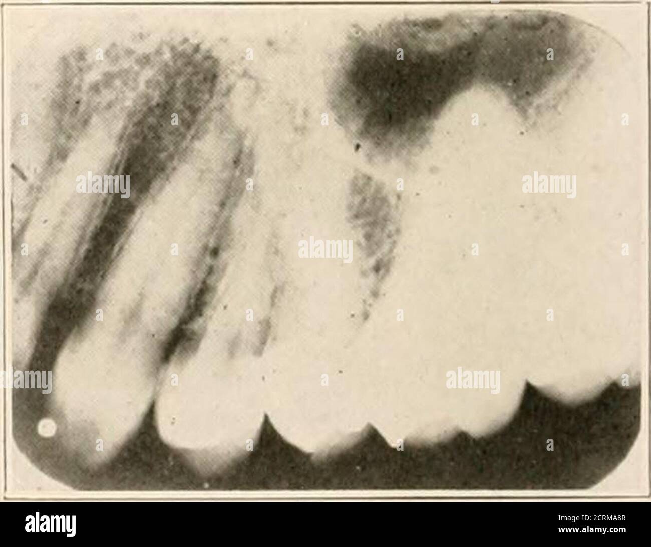 Interpretation Of Dental And Maxillary Roentgenograms Fig 92 Fig