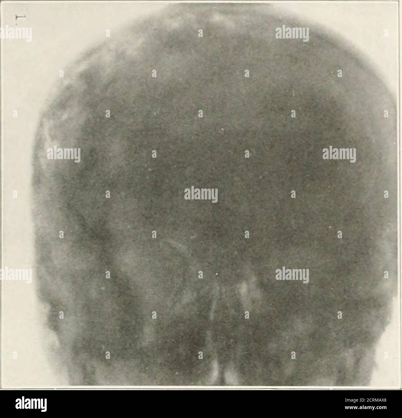 . Roentgen diagnosis of diseases of the head . ilepsy). Case 1.—Female ...