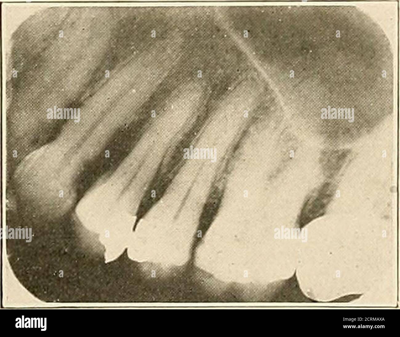 . Interpretation of dental & maxillary roentgenograms . Fig. 88. Fig ...