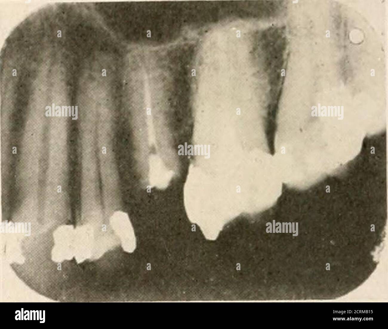 . Interpretation of dental & maxillary roentgenograms . Fig. 90. Fig ...