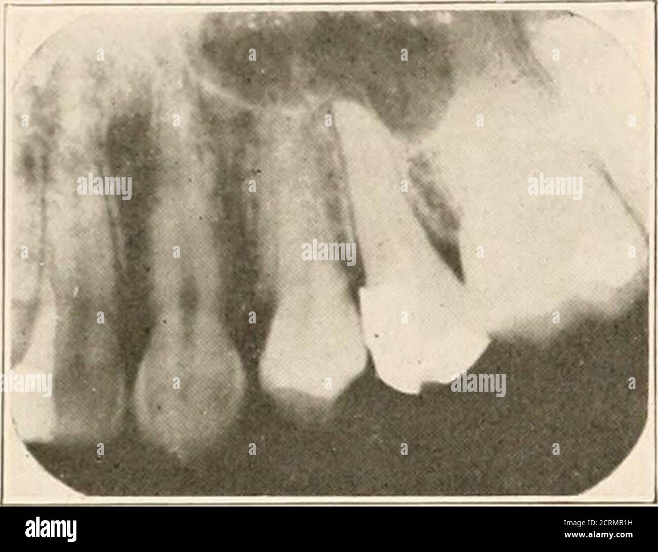 . Interpretation of dental & maxillary roentgenograms . Fig. 88. Fig ...