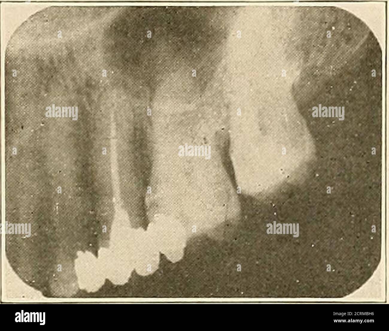 . Interpretation of dental & maxillary roentgenograms . Fig. 86. Fig ...