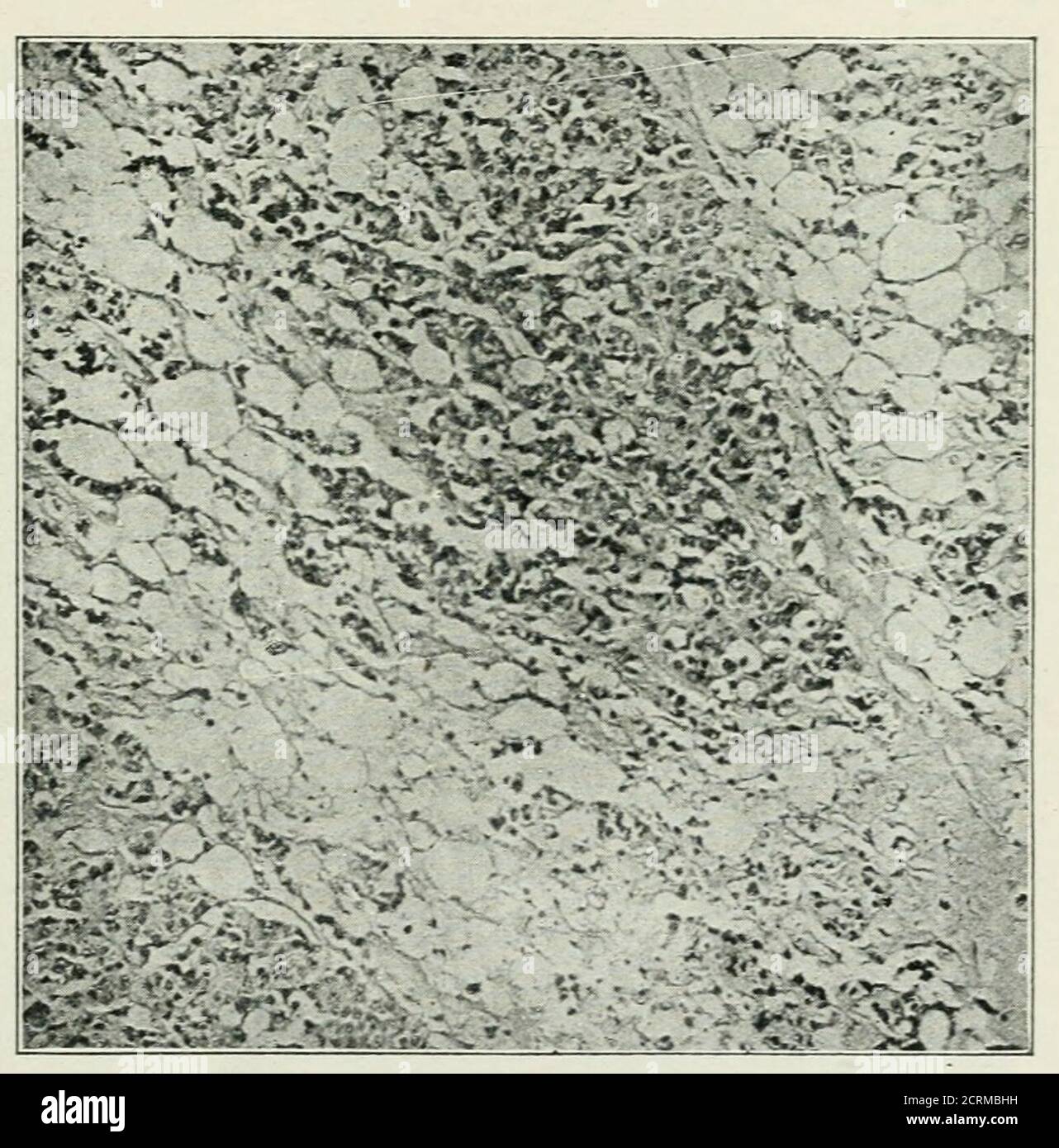 Cancercells hi-res stock photography and images - Alamy