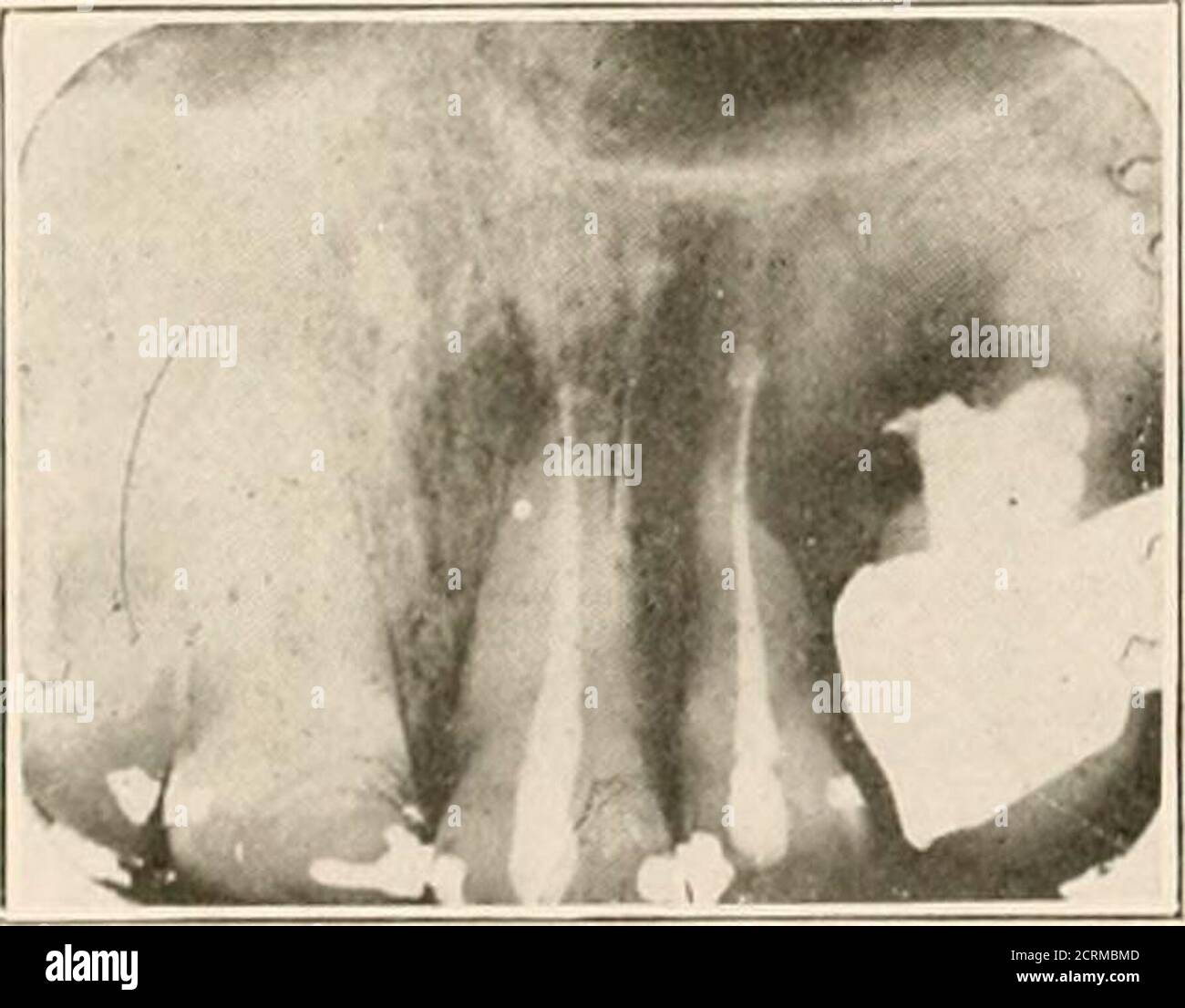 . Interpretation of dental & maxillary roentgenograms . Fig. 82. Fig ...