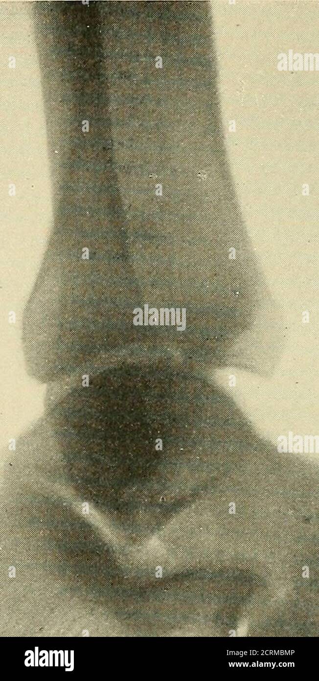 . Röntgen ray diagnosis and therapy . Fig. 13.—Lateral Dislocation of ...