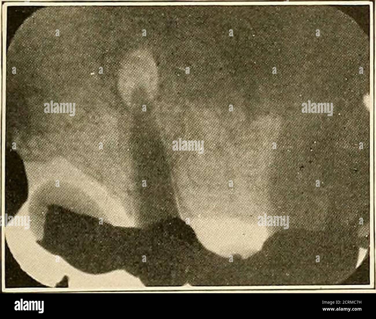 . Oral sepsis in its relationship to systemic disease . Fig. 93. Fig ...