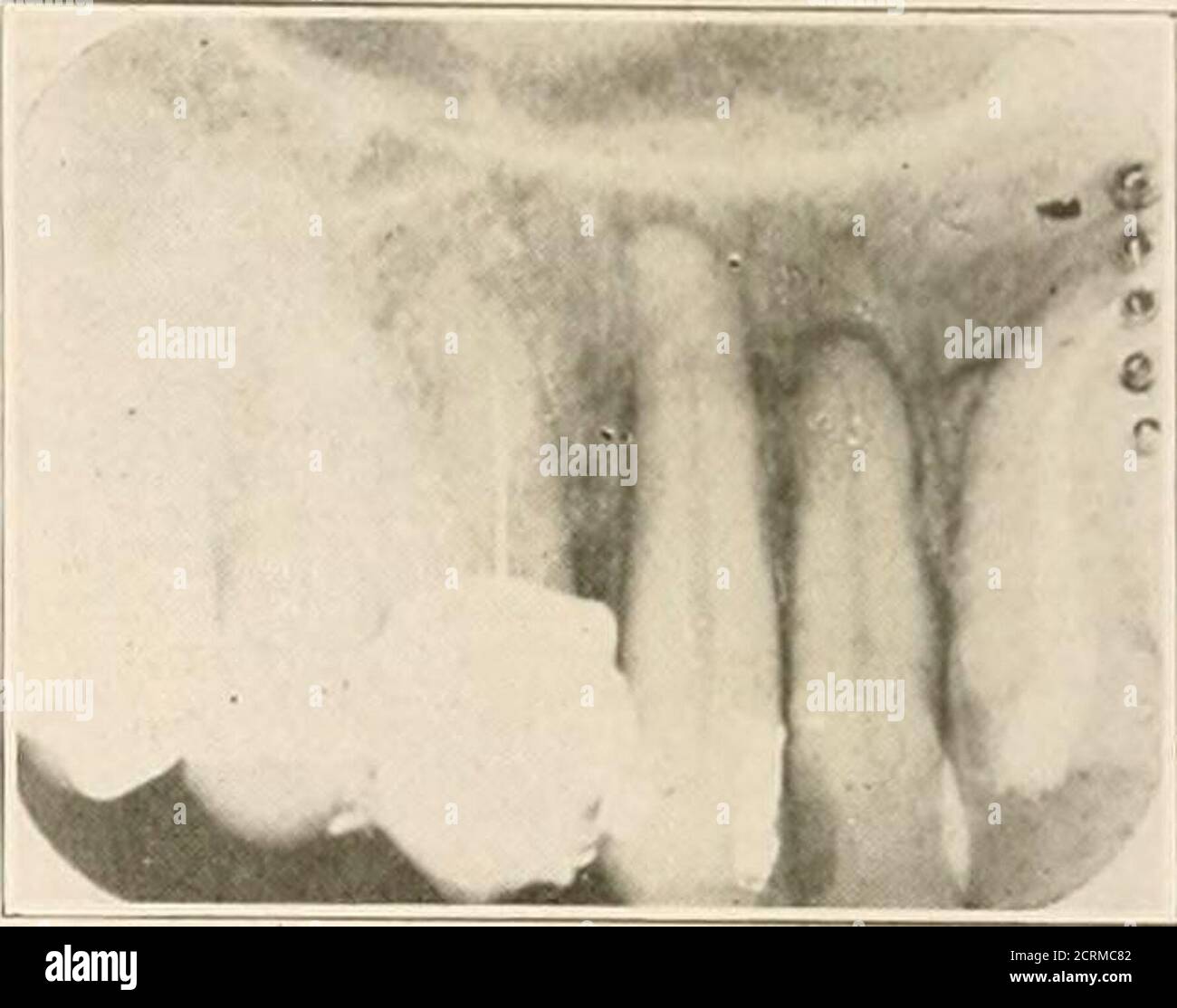. Interpretation of dental & maxillary roentgenograms . Fig. 82. Fig ...