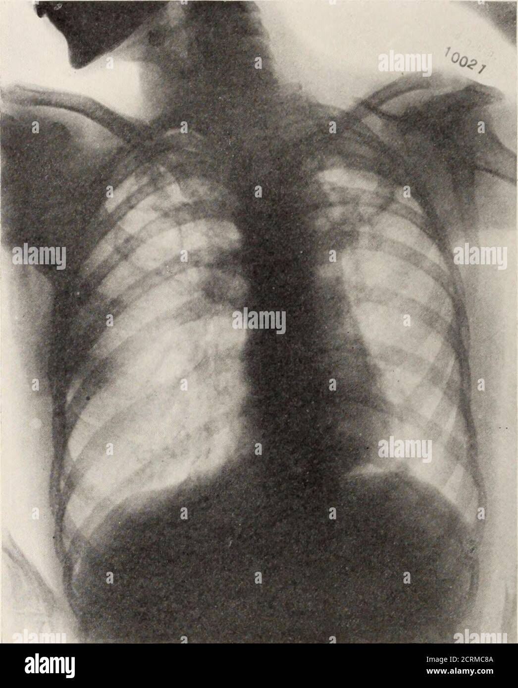 Lung cavitation hi-res stock photography and images - Alamy