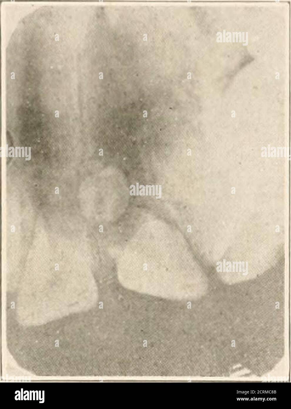 . Interpretation of dental & maxillary roentgenograms . Fig. 80. Fig ...