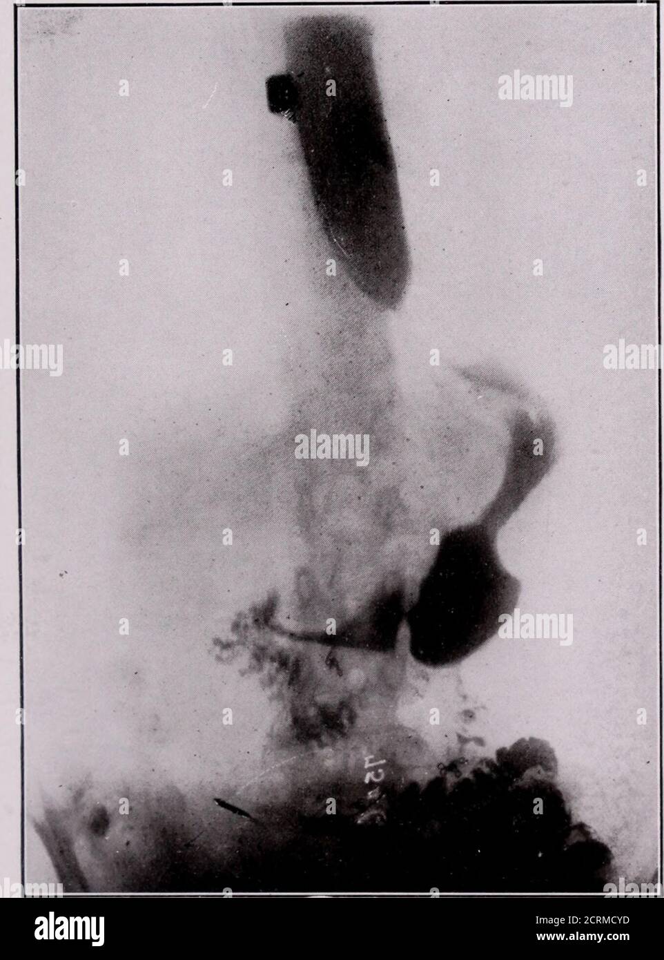 Gastro cardio hi-res stock photography and images - Alamy