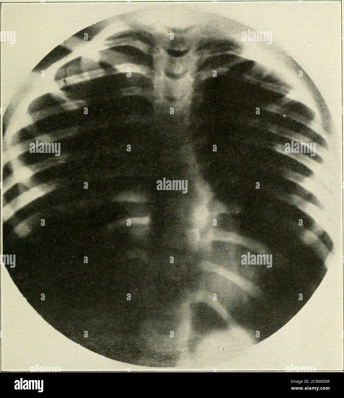 Bifid rib hi-res stock photography and images - Alamy