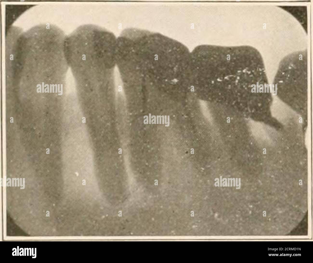 . Oral sepsis in its relationship to systemic disease . Fig. 86. Fig ...